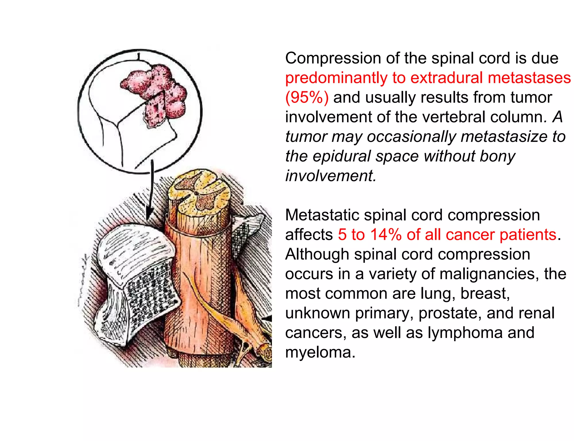 Maliganant spinal cord compression main | PPT