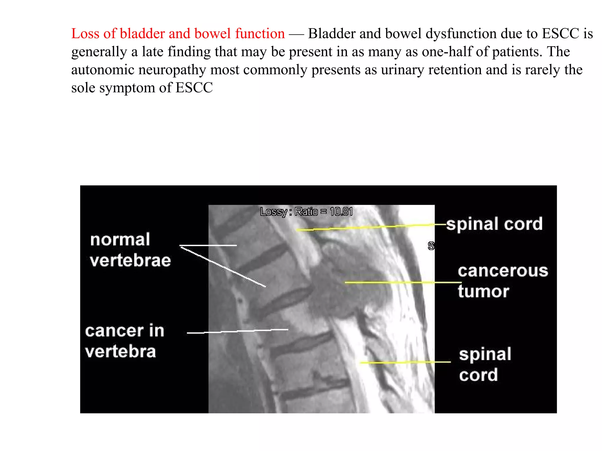 Maliganant spinal cord compression main | PPT