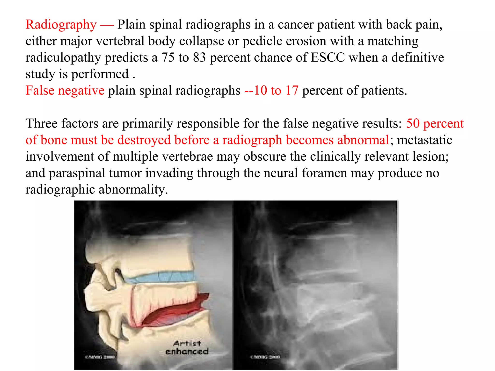 Maliganant spinal cord compression main | PPT