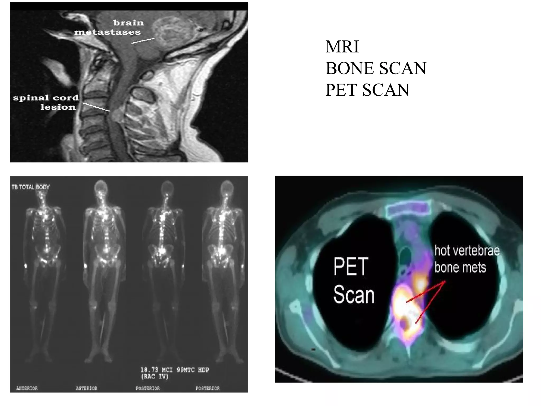 Maliganant spinal cord compression main | PPT