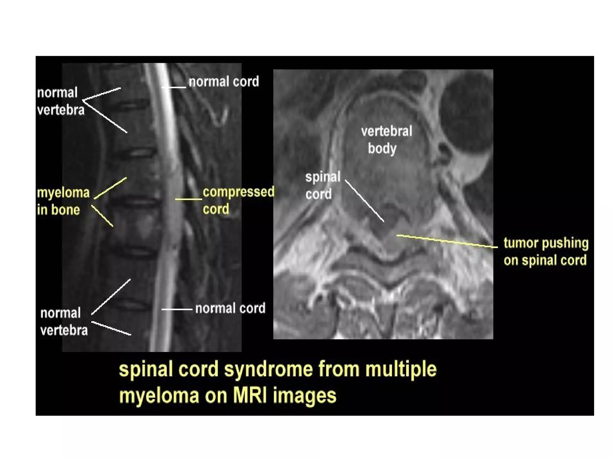 Maliganant spinal cord compression main | PPT
