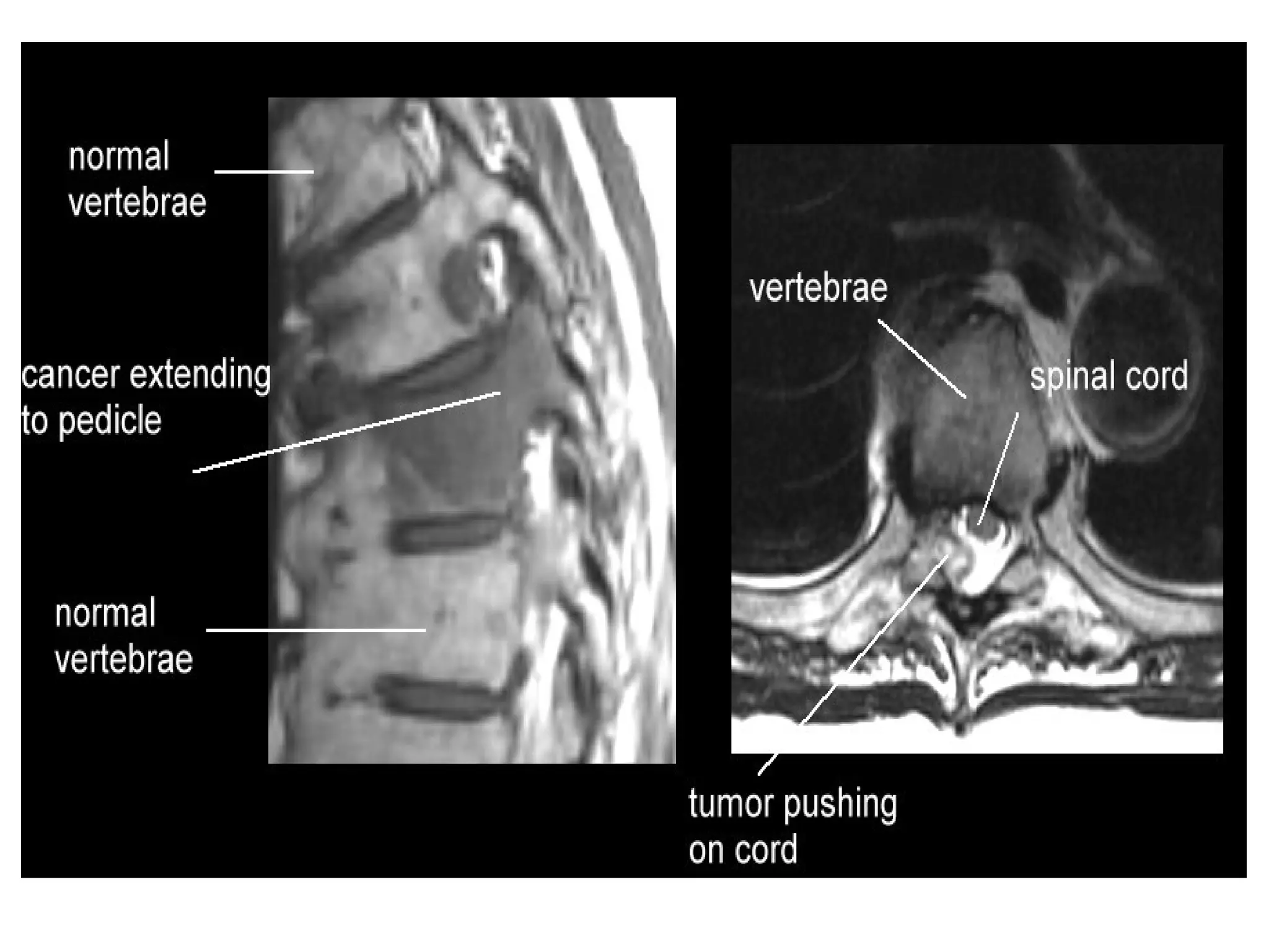 Maliganant spinal cord compression main | PPT