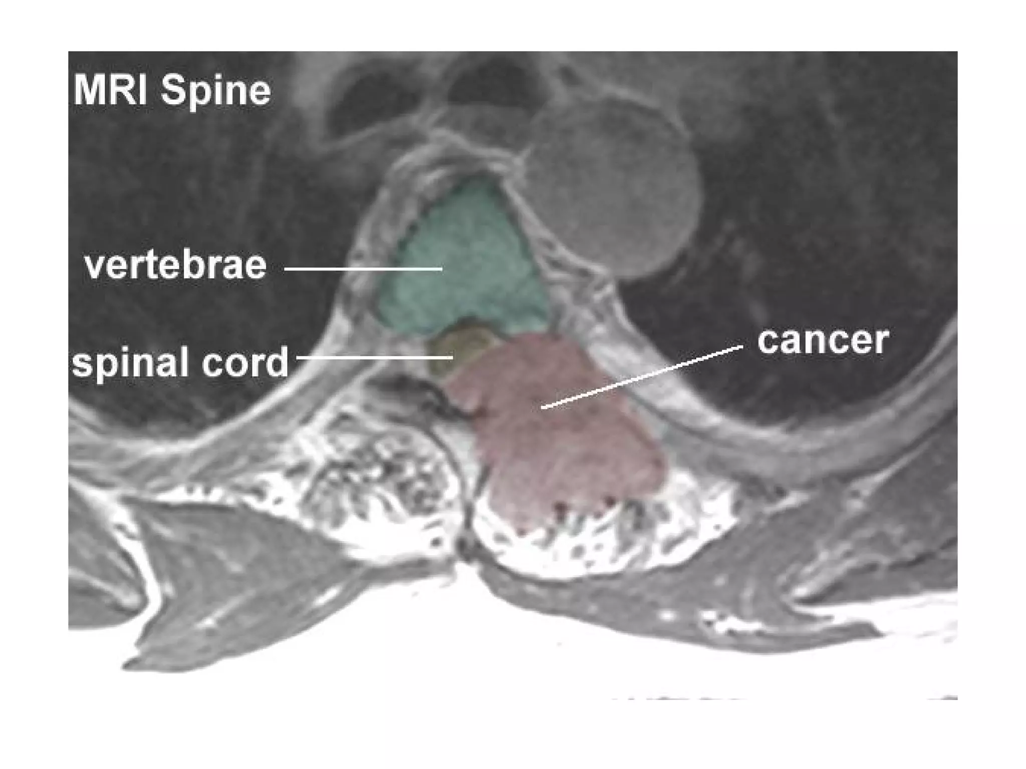 Maliganant spinal cord compression main | PPT