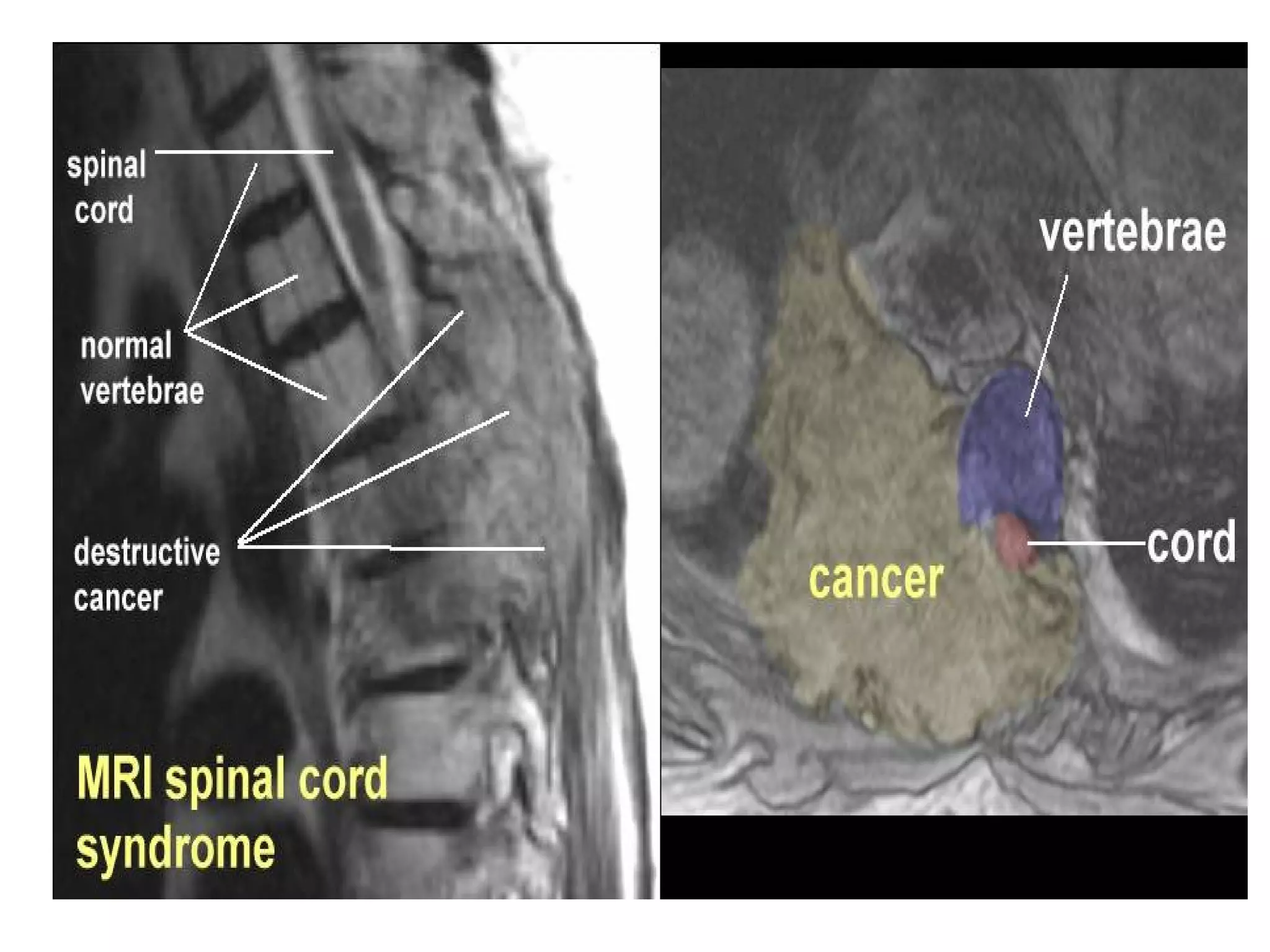 Maliganant spinal cord compression main | PPT