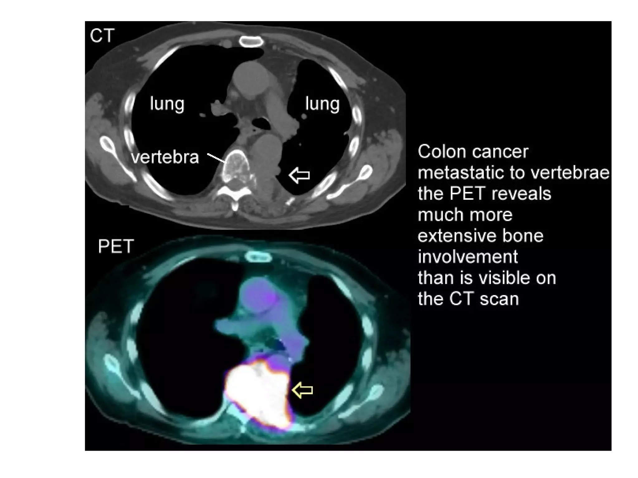 Maliganant spinal cord compression main | PPT