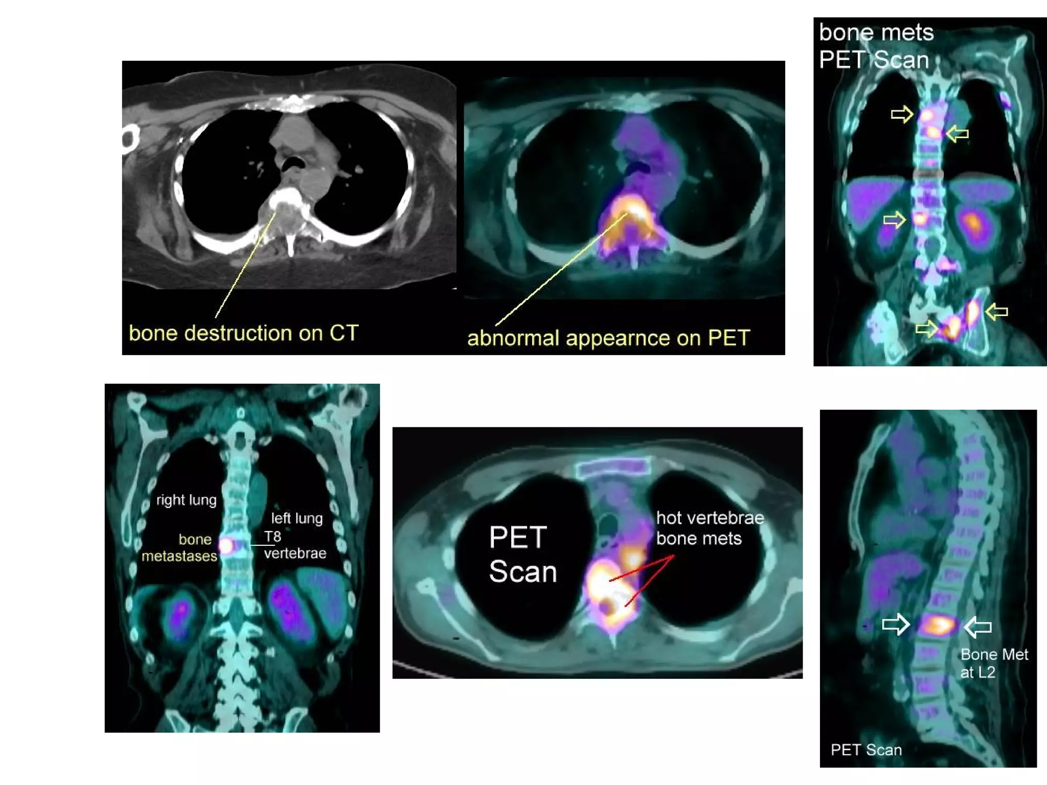 Maliganant spinal cord compression main | PPT