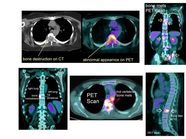 Maliganant spinal cord compression main | PPT