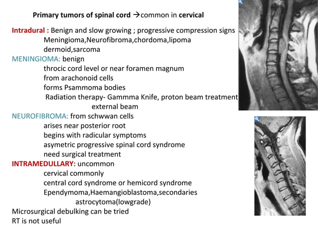 Maliganant spinal cord compression main | PPT
