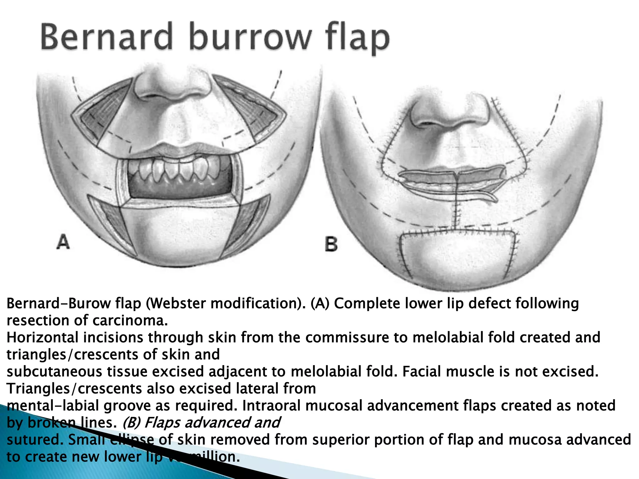 Malignancy of lip | PPTX