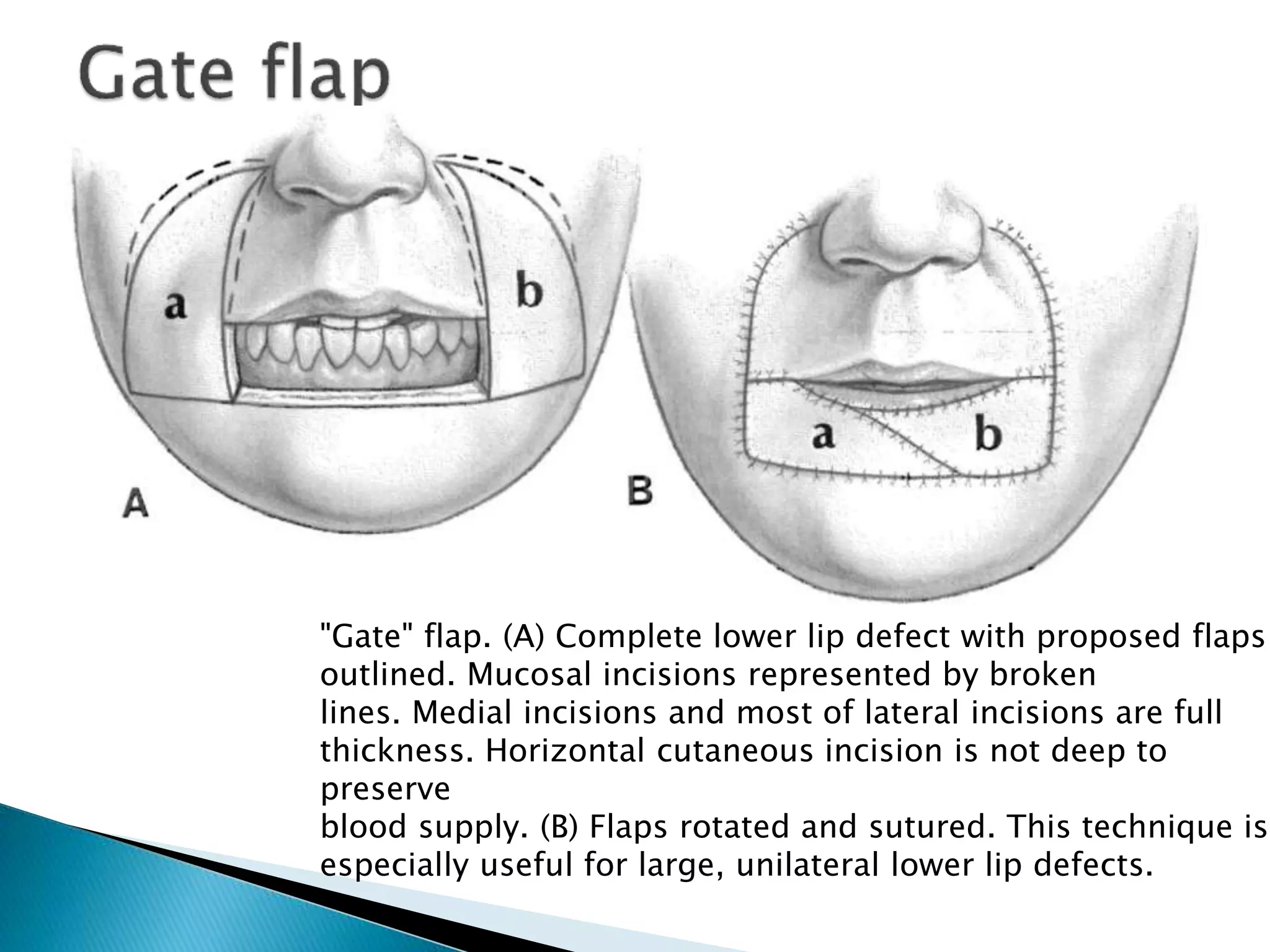Malignancy of lip | PPTX