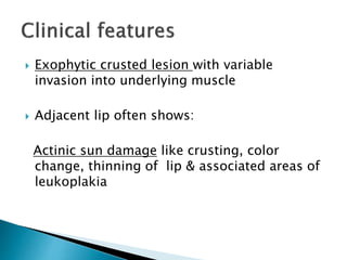 Malignancy of lip | PPTX
