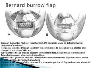 Malignancy of lip | PPT