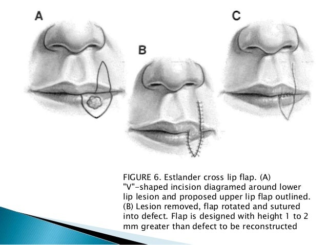 Malignancy of lip