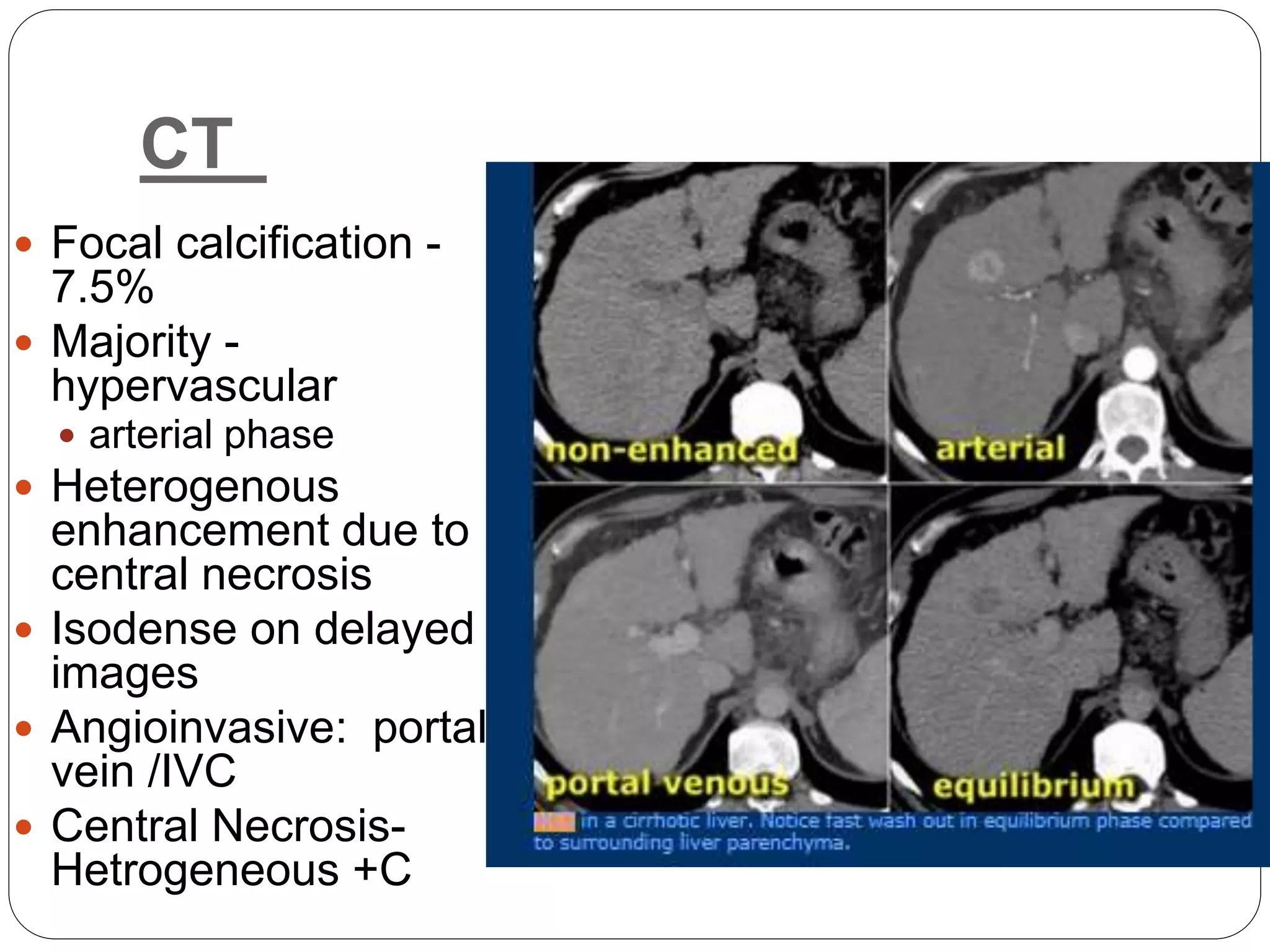 HEPATOCELLULAR CARCINOMA RADIOLOGY | PPTX