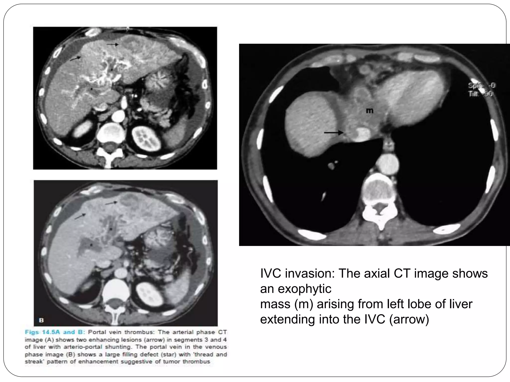 HEPATOCELLULAR CARCINOMA RADIOLOGY | PPTX