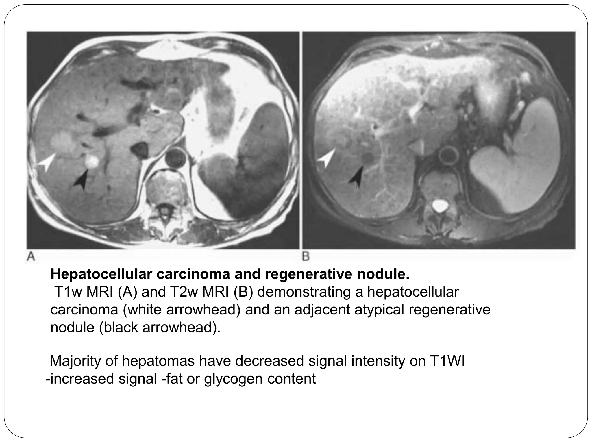 HEPATOCELLULAR CARCINOMA RADIOLOGY | PPTX