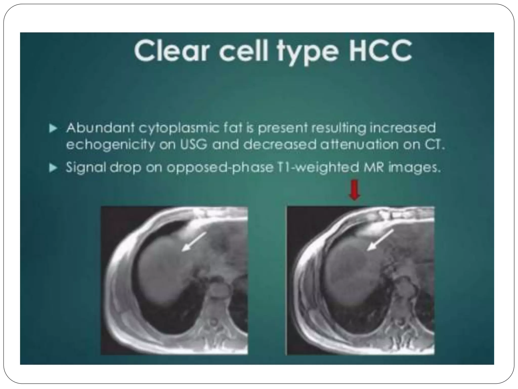 HEPATOCELLULAR CARCINOMA RADIOLOGY | PPTX