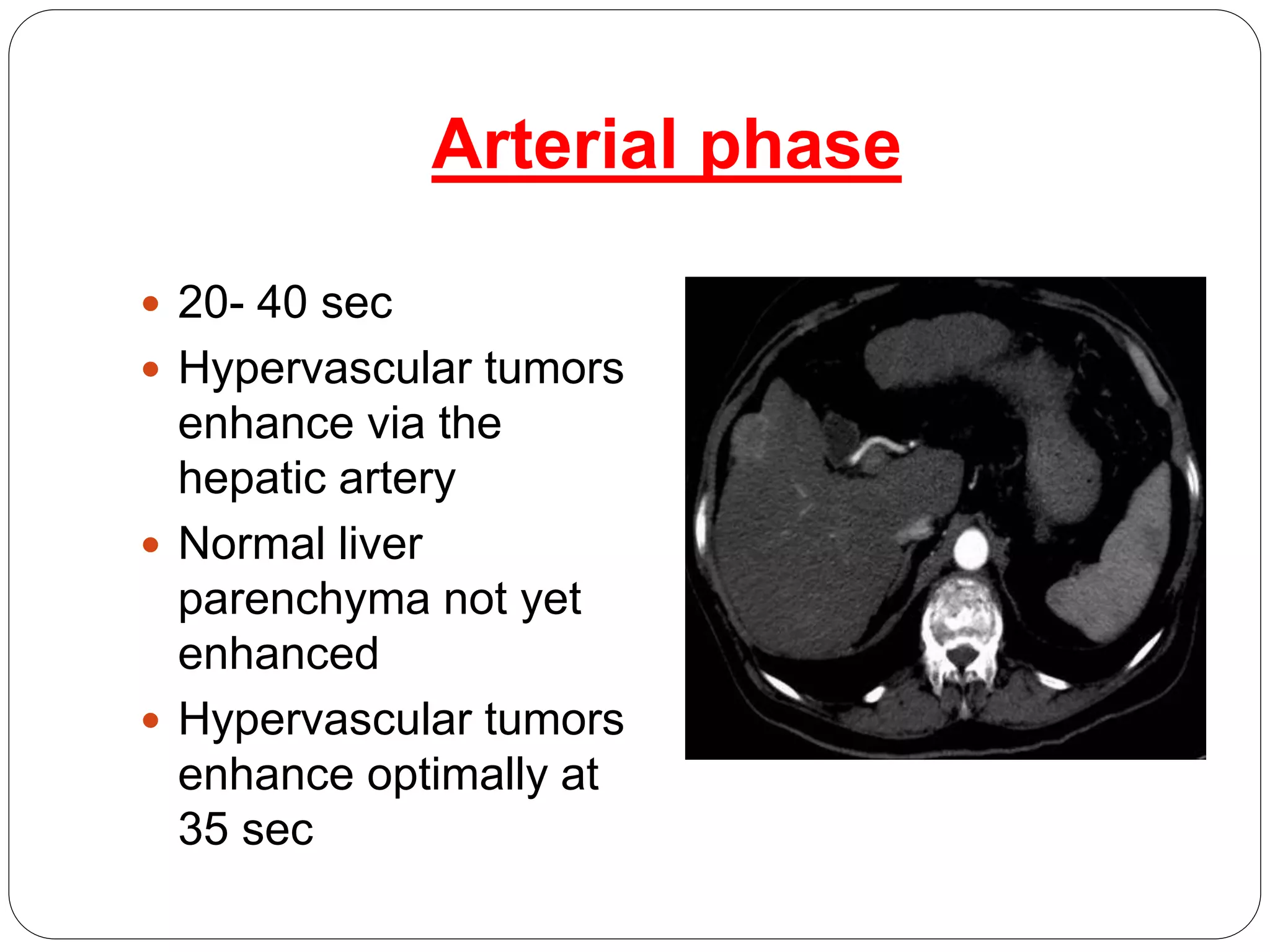 HEPATOCELLULAR CARCINOMA RADIOLOGY | PPTX