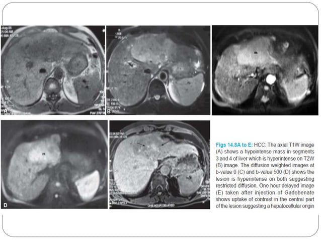 HEPATOCELLULAR CARCINOMA RADIOLOGY