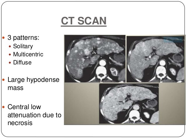HEPATOCELLULAR CARCINOMA RADIOLOGY