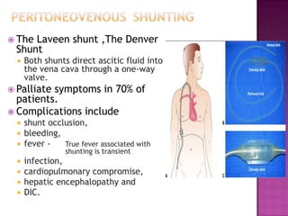 Peritoneovenous Shunt