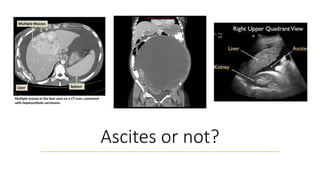 Pathology and Management of Malignant ascites | PPTX