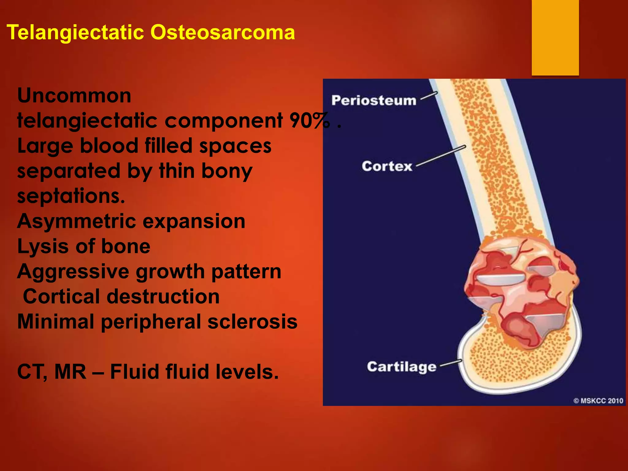 Malignant bone Tumors,Radiology | PPTX