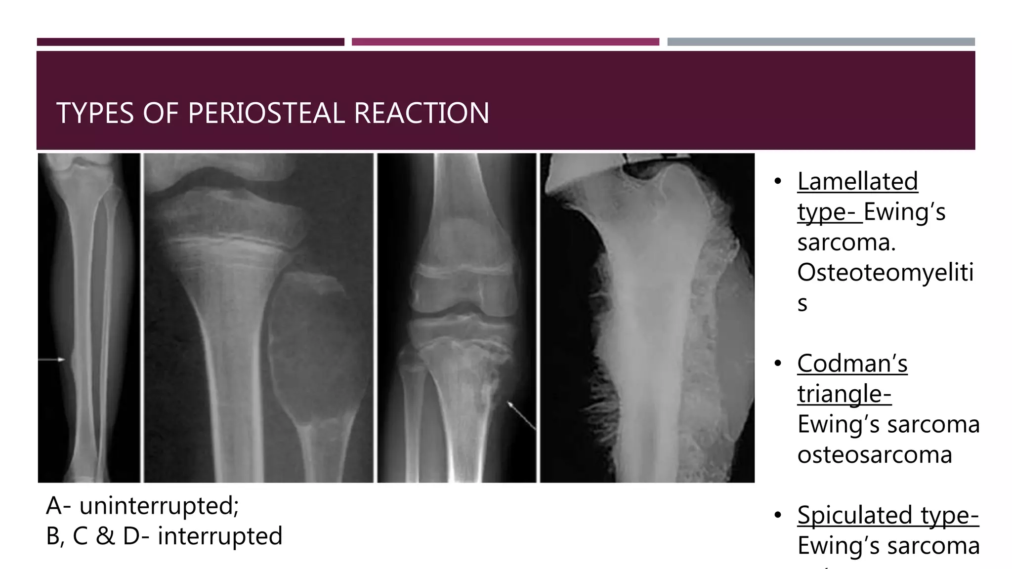 Malignant bone tumor | PPTX