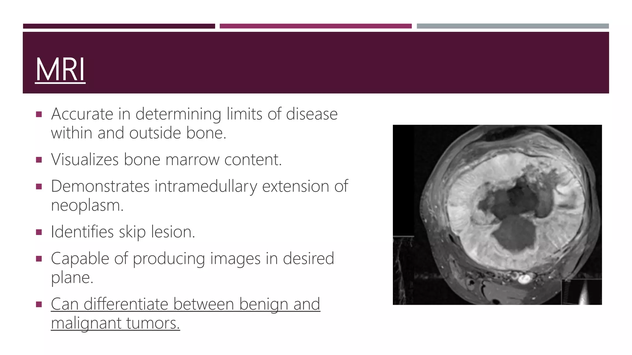 Malignant bone tumor | PPTX