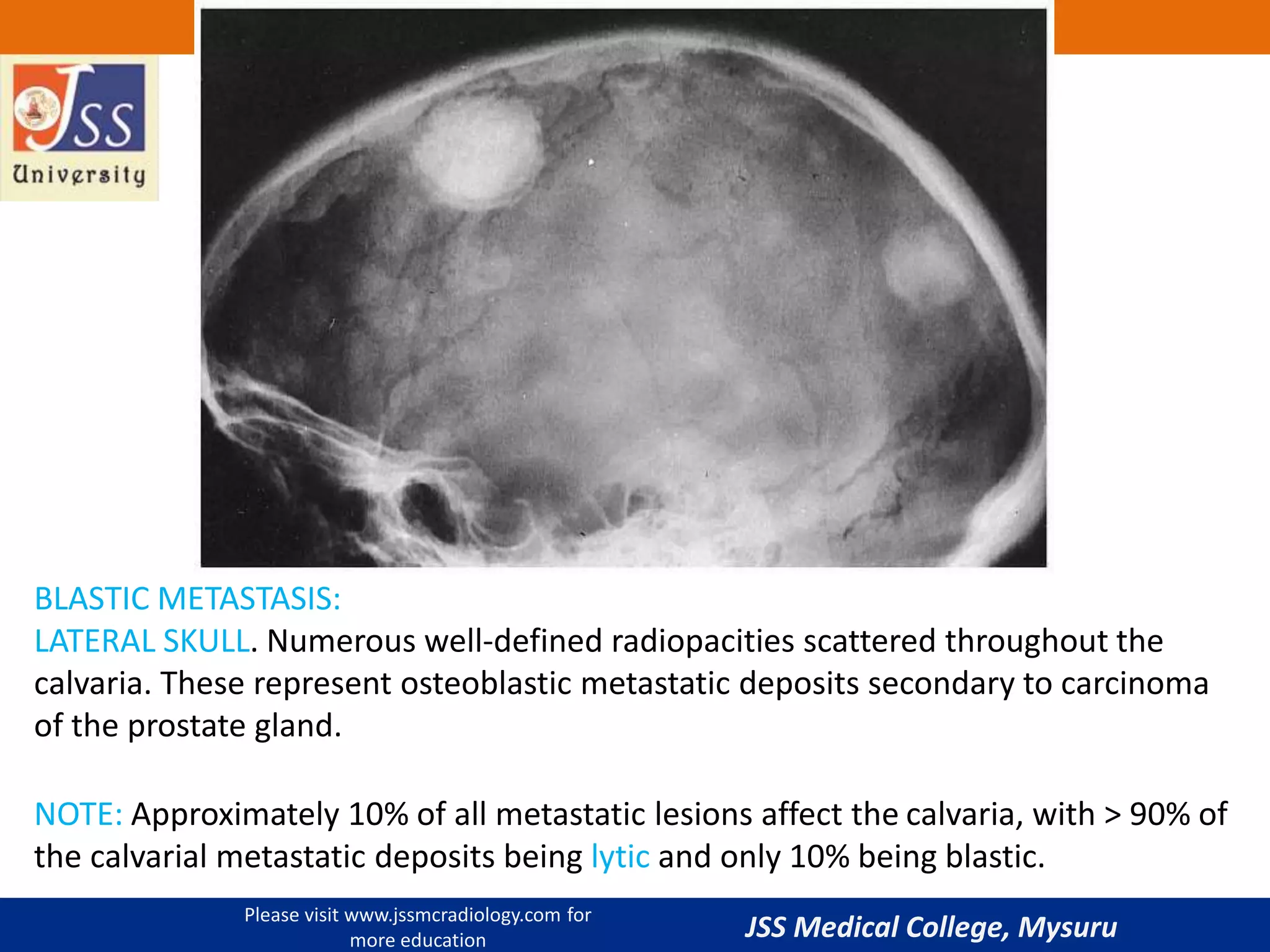 Imaging in malignant bone tumors | PPTX