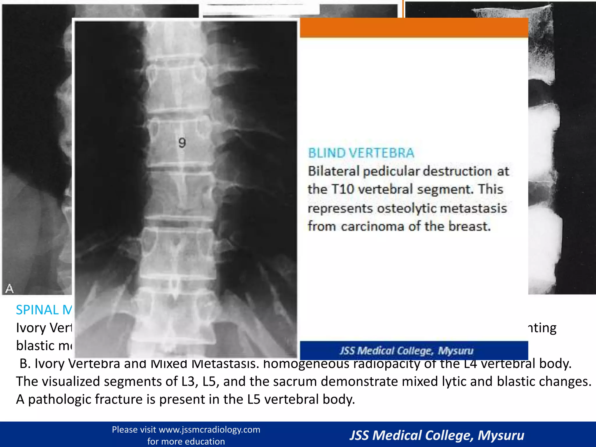 Imaging in malignant bone tumors | PPTX
