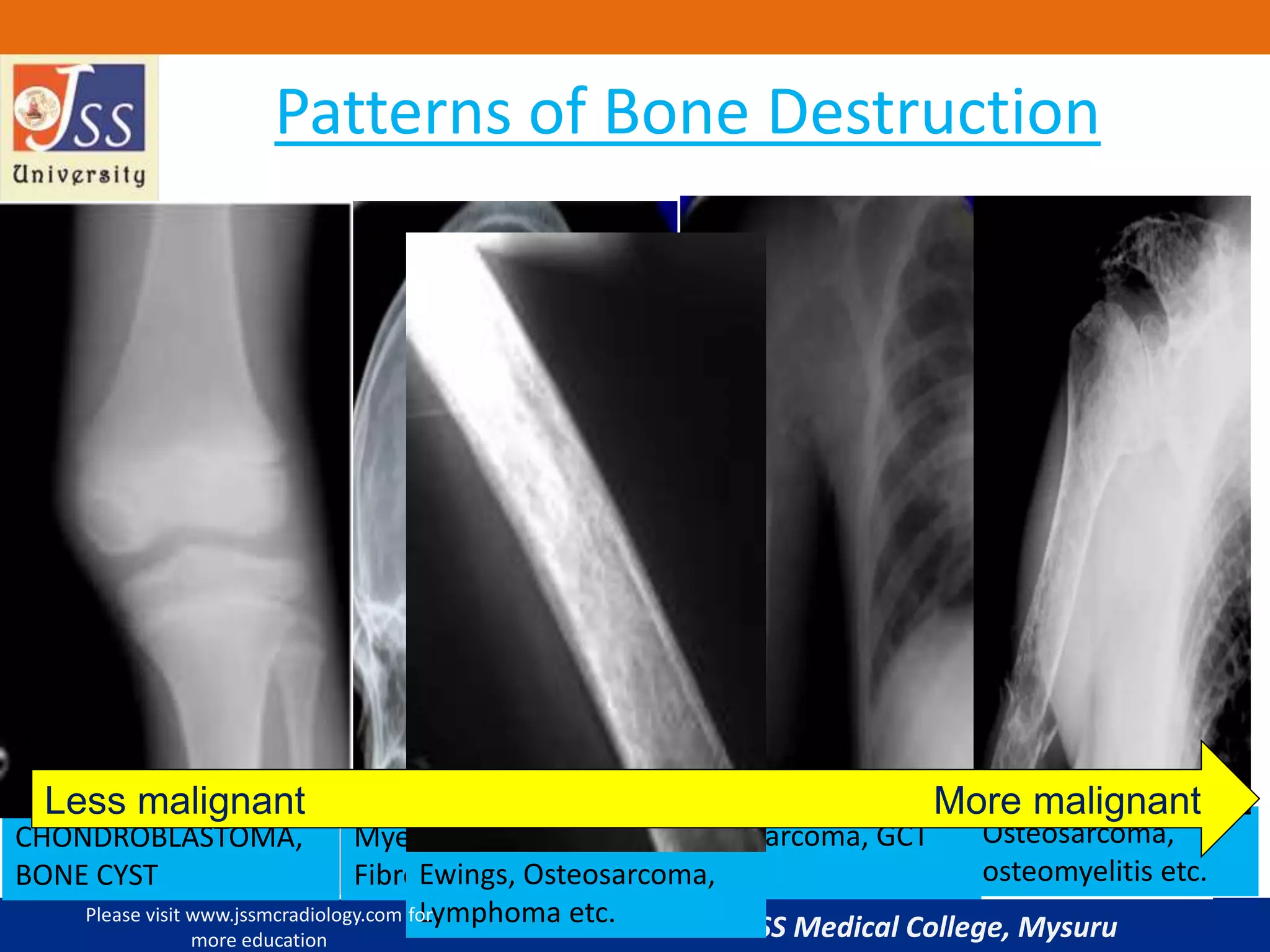 Imaging in malignant bone tumors | PPTX