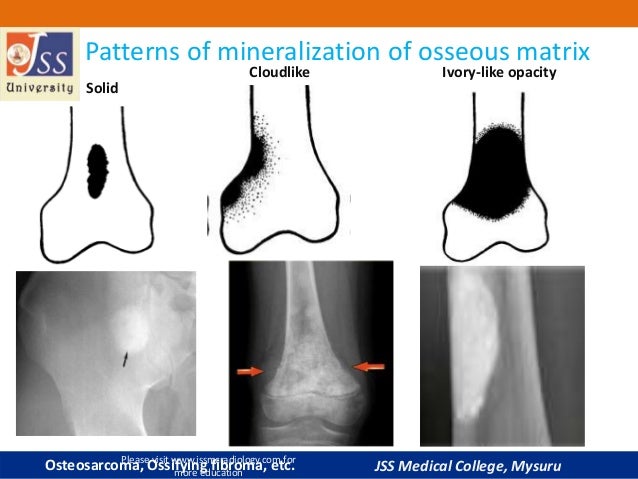 Imaging in malignant bone tumors