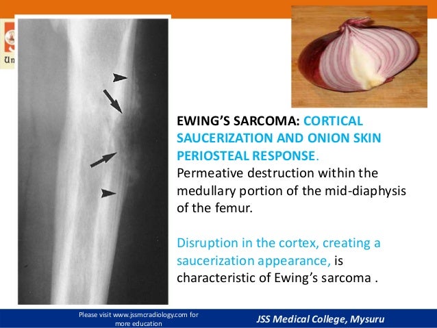 Ewings Sarcoma Femur