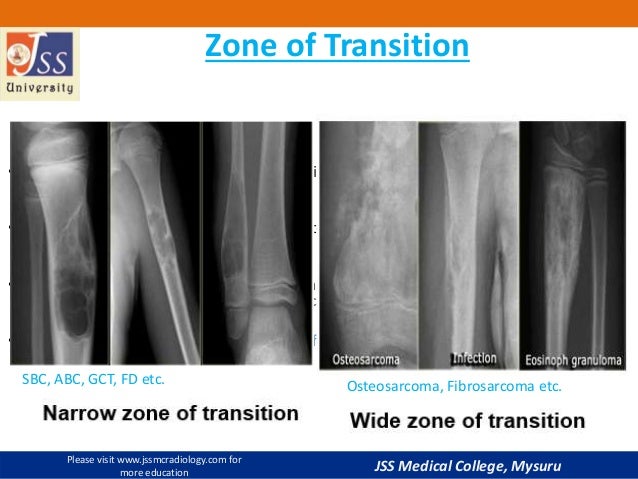 Imaging in malignant bone tumors