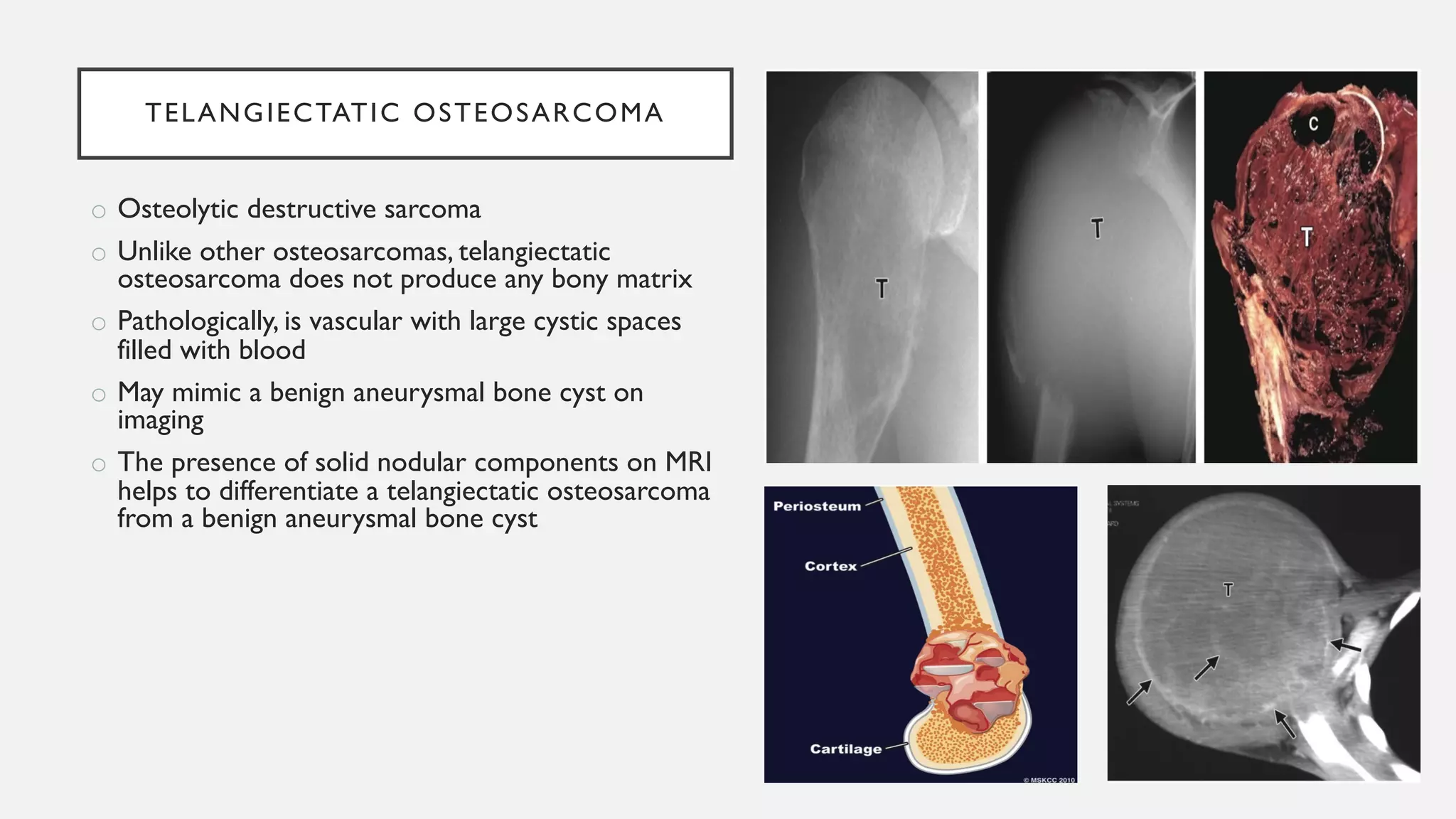 Radiology Malignant bone tumors | PDF