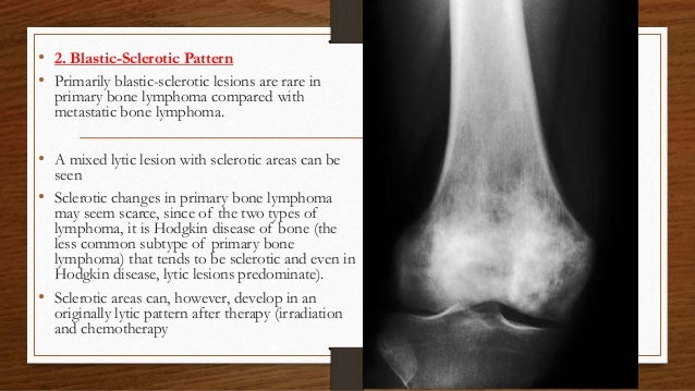 Malignant bone tumors 2