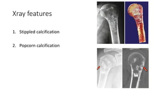 Malignant bone tumors (Nutshell) | PPT