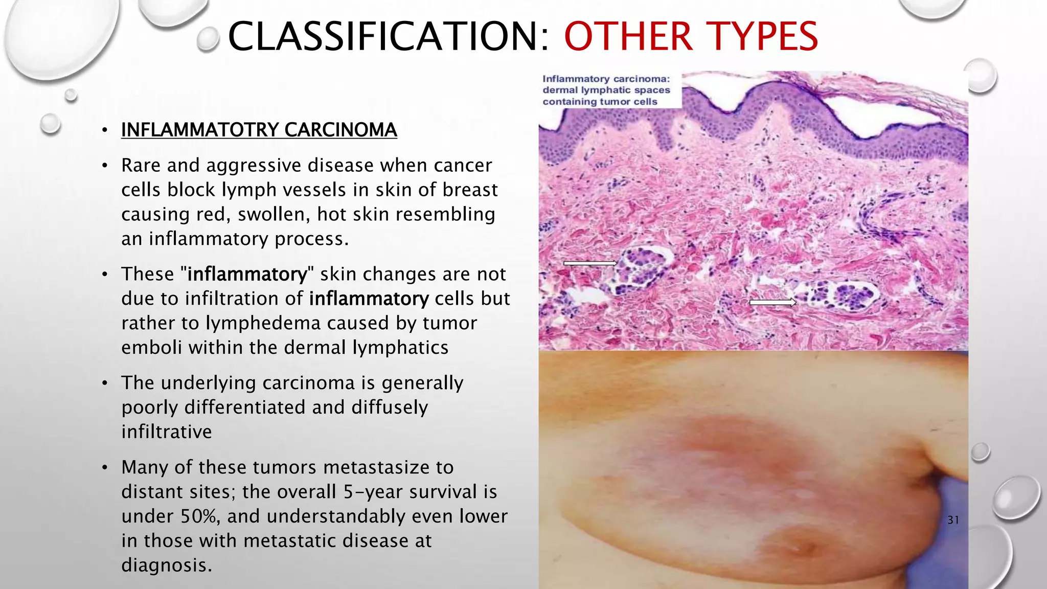 MALIGNANT BREAST LESIONS.pptx