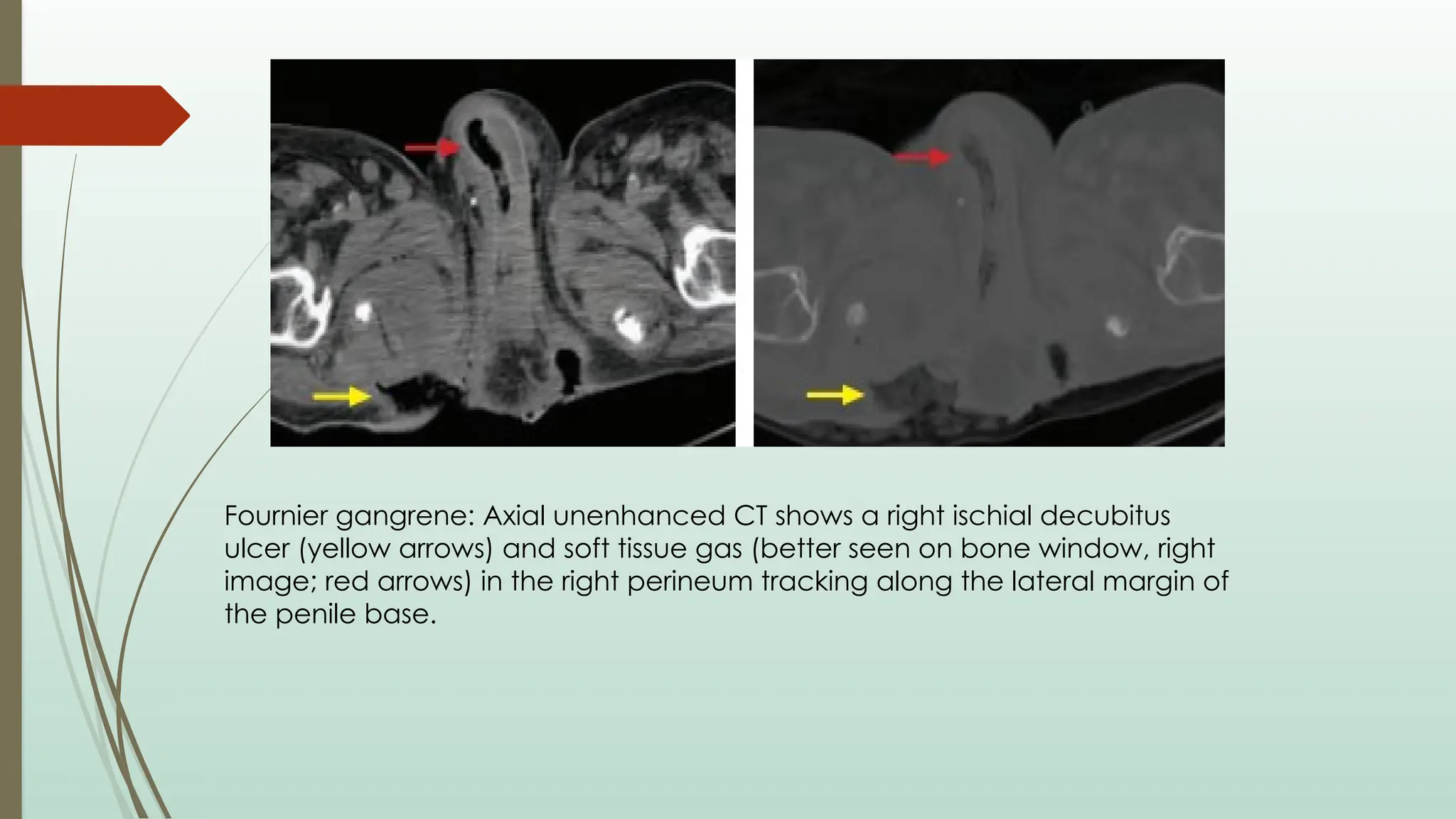 malignant diseases of uterus and vagina.pptx