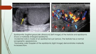 malignant diseases of uterus and vagina.pptx
