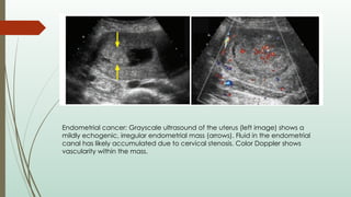 malignant diseases of uterus and vagina.pptx