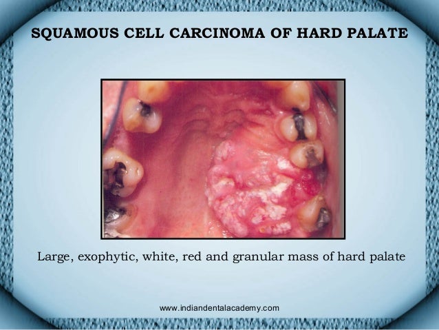 Malignant epithelial tumors ii/ dental implant courses