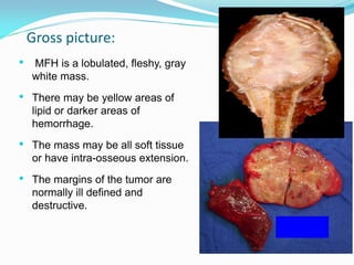 Malignant fibrous histiocytoma, Undifferntiated pleomorphic sarcoma | PDF