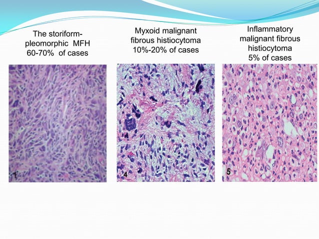 Malignant fibrous histiocytoma, Undifferntiated pleomorphic sarcoma ...