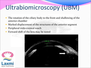 Malignant glaucoma | PPTX