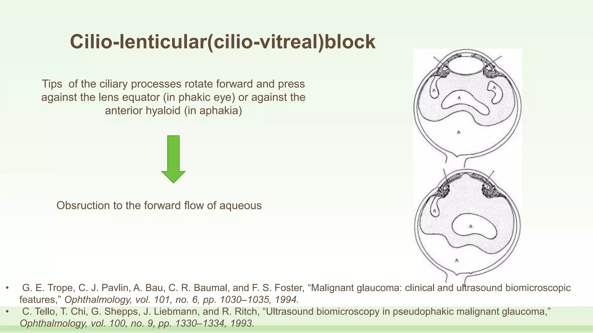 Malignant glaucoma - Dr Shylesh B Dabke | PPTX