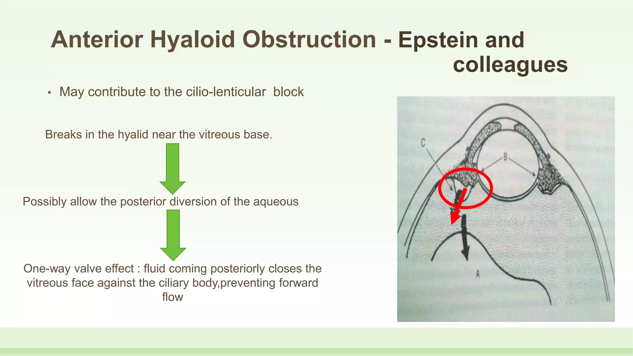 Malignant glaucoma - Dr Shylesh B Dabke | PPTX