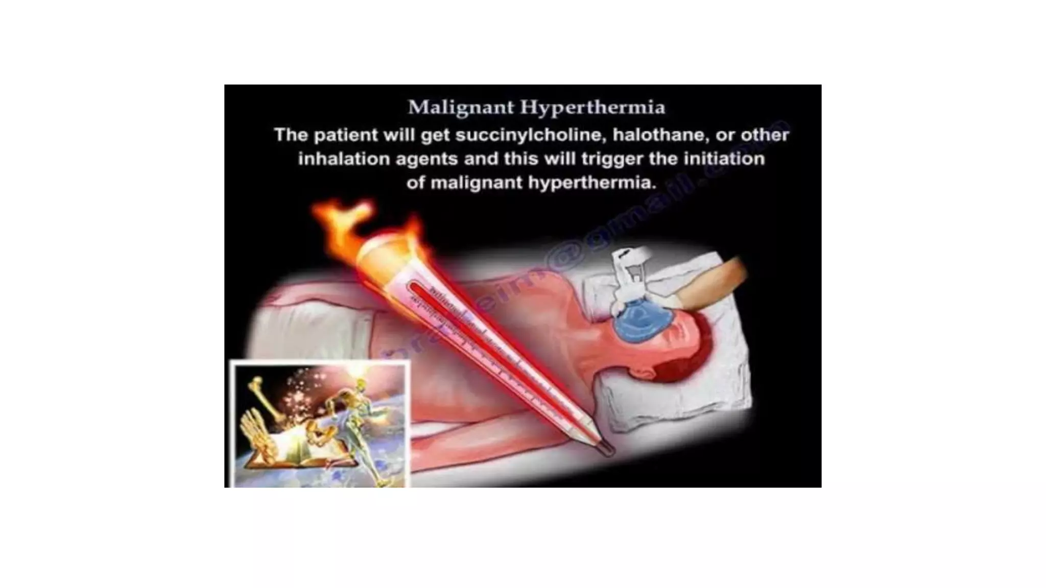 MALIGNANT HYPERTHERMIA.pptx