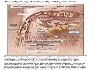 Malignant Hyperthermia Poster